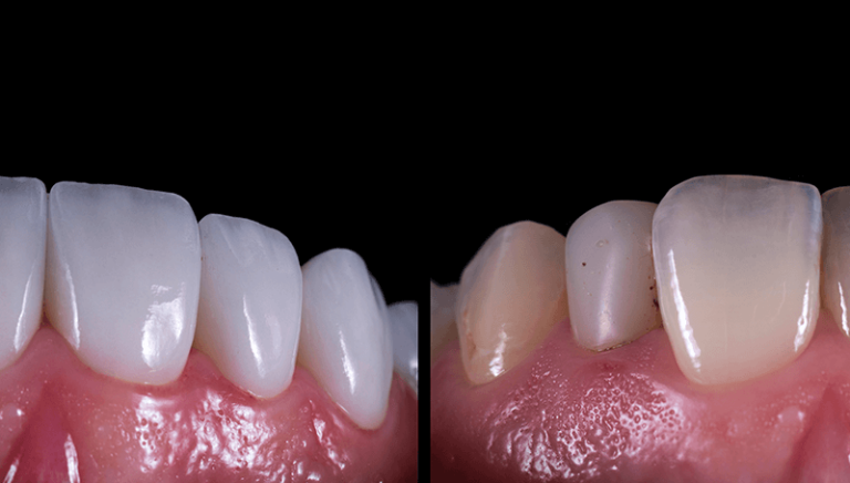 Veneers types - All important information