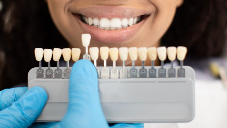Veneers Color - About Discoloration & Natural Tooth Shades