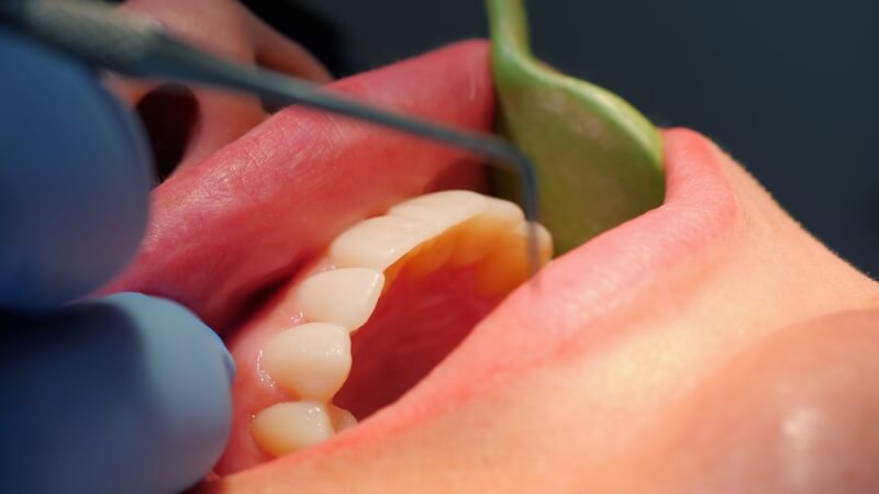 Are veneers harmful? Information & Notes