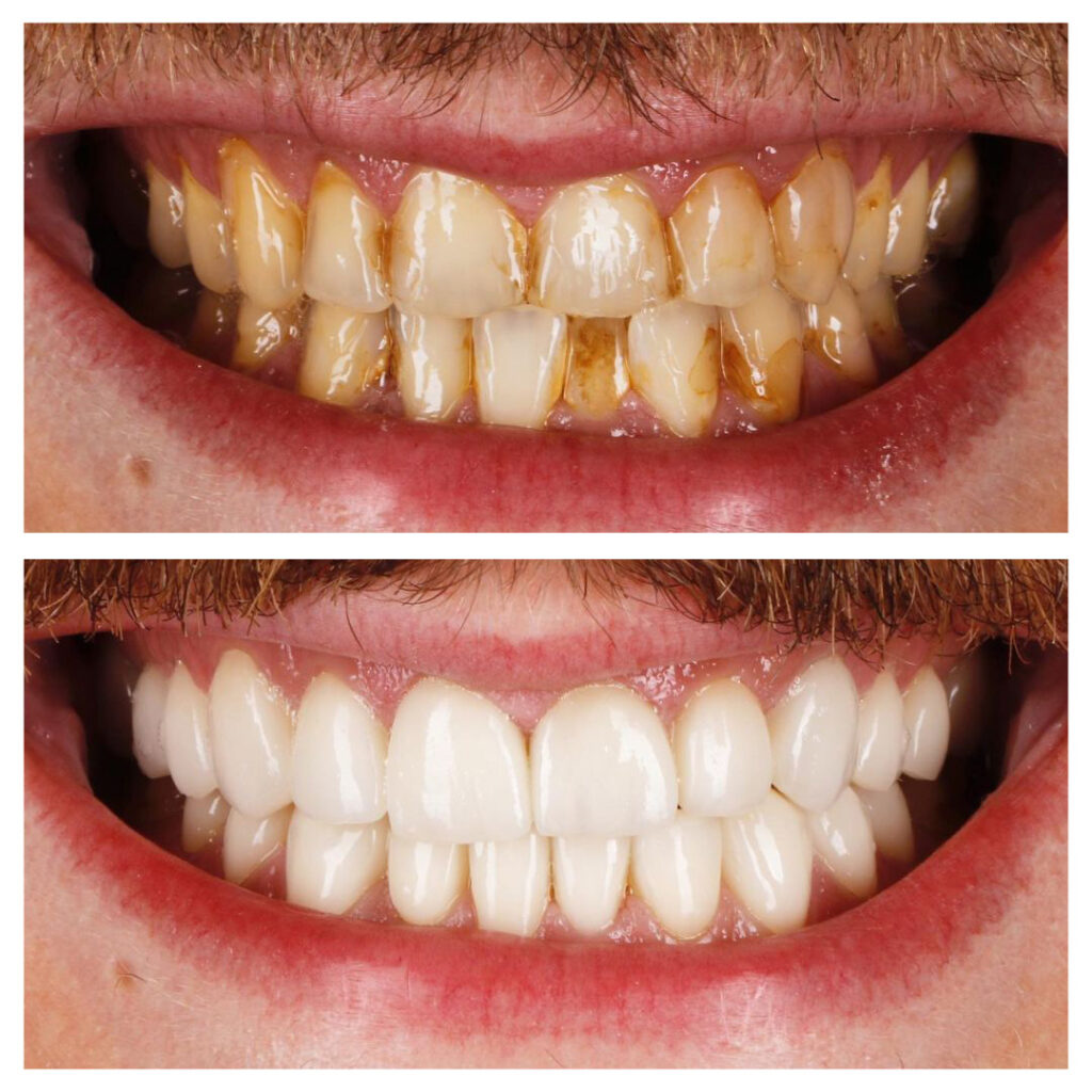Veneers Before & After Pictures | Flawless & Natural Teeth