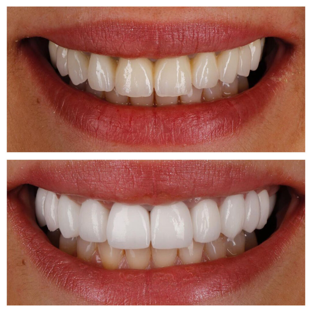 Veneers Before & After Pictures | Flawless & Natural Teeth