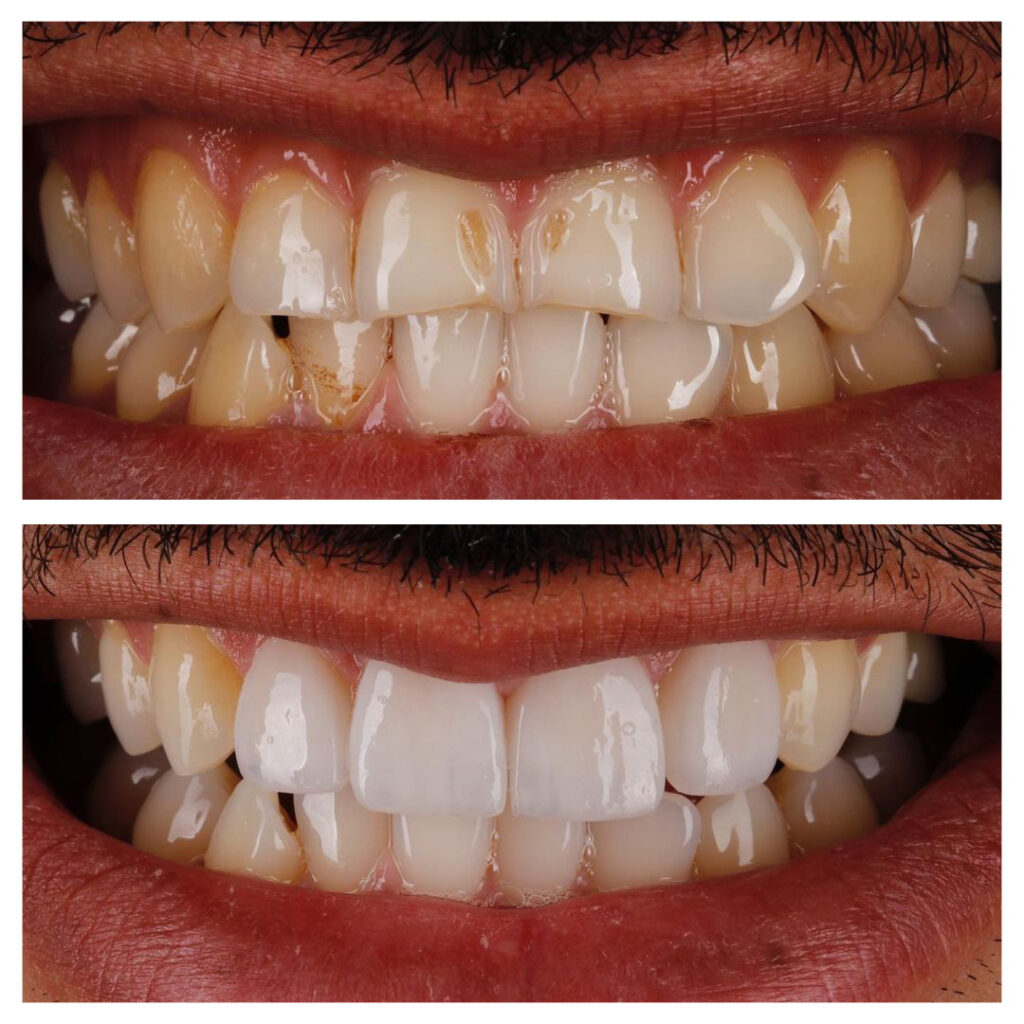 Veneers Before & After Pictures | Flawless & Natural Teeth