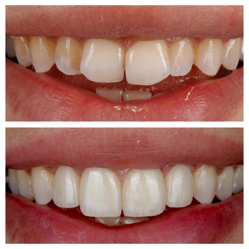 Veneers Before & After Pictures | Flawless & Natural Teeth