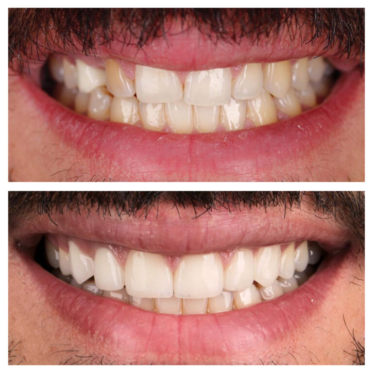 Veneers Before & After Pictures | Flawless & Natural Teeth